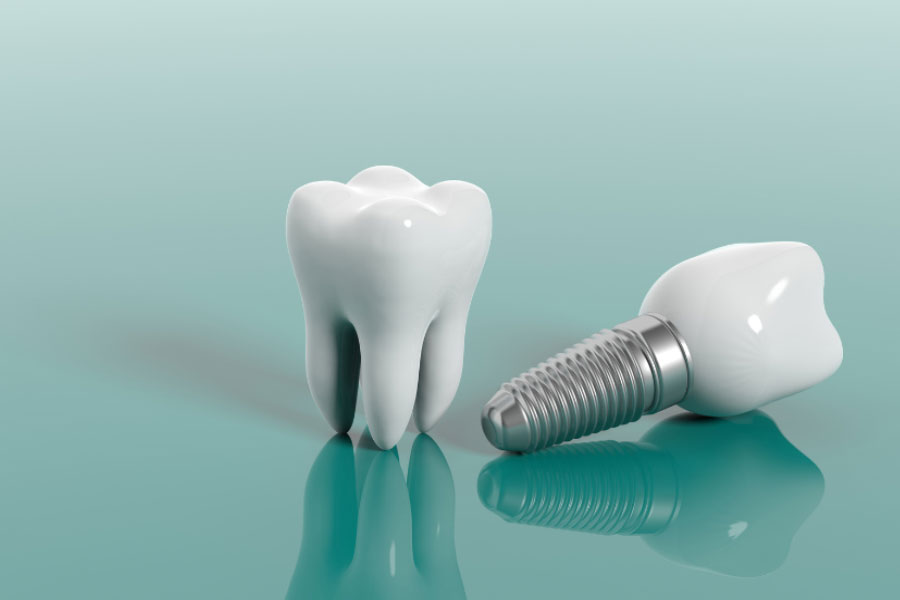 A Guide to Your Tooth Replacement Options - Inspire Buddy